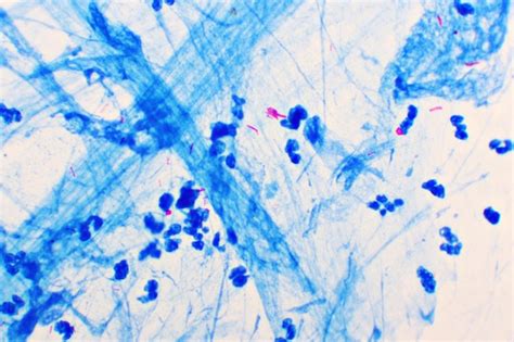 Mycobacterium Tuberculosis Acid Fast