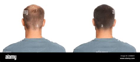 Man Before And After Hair Treatment With High Frequency Darsonval