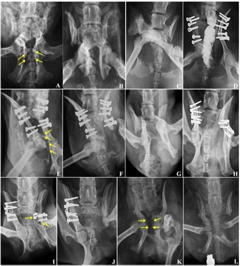 Bilateral Hemipelvectomy