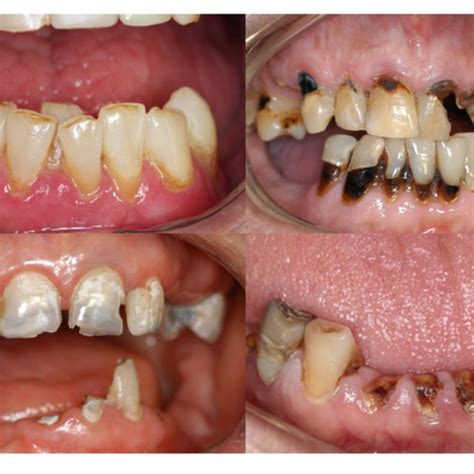 Difference Between Clinical Conditions Of Conventional And Radiation