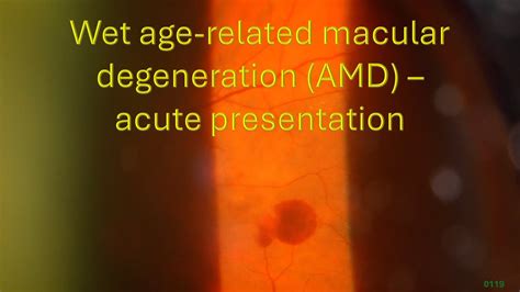 Age Related Macular Degeneration Causes Symptoms And Treatment