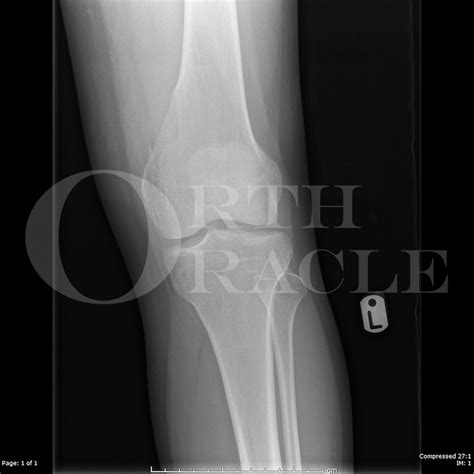 Excision Of Osteochondroma From The Medial Distal Femur Orthoracle Luanmd