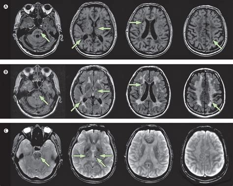 Cadasil The Lancet Neurology