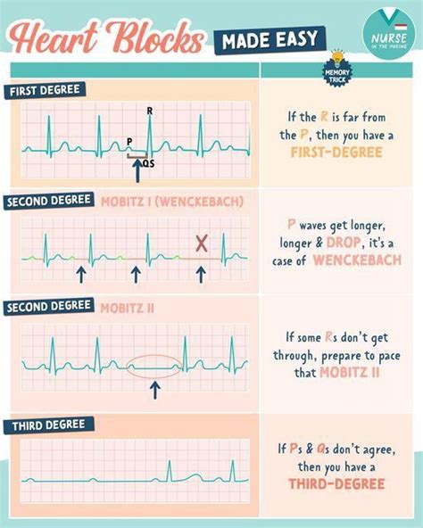 How To Remember Heart Blocks Heart Blocks Made Easy Nursing Ecg