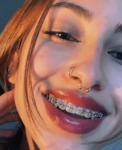 Pin By John Beeson On Girls In Braces Braces Girls Cute Girls With