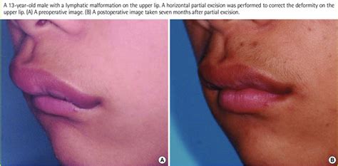 A Lymphatic Malformation Patient Download Scientific Diagram