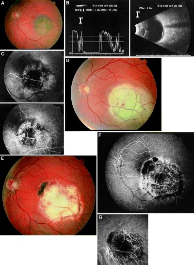 Primary Transpupillary Thermotherapy Ttt For Malignant Choroidal