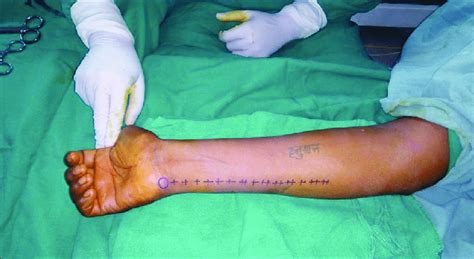 The Planned Incision From Pisiform To Proximal Forearm Ulno Volar Download Scientific Diagram