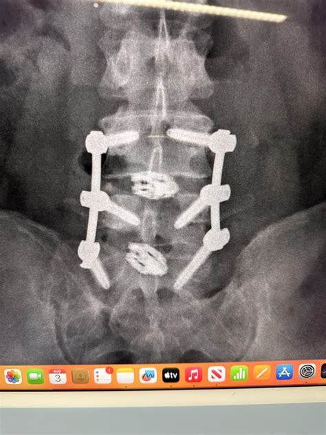 5 Weeks Post Op L3l5 Tlif Rspinalfusion