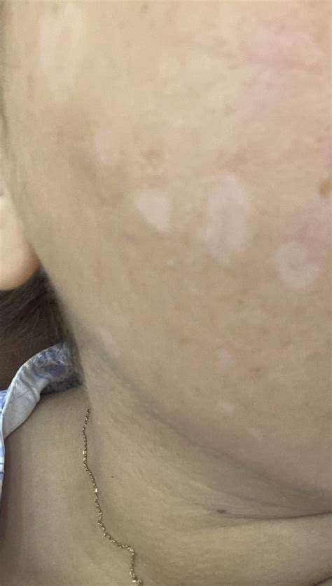 How To Get Rid Of White Spots After Healed Psoriasis R Psoriasis