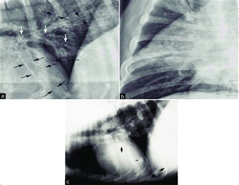 A Bronchial Pattern 24 B Lobar Sign 24 And C Cotton Like
