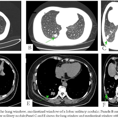 Ct Image Of The Case Note Panels A And D Show The Lung Window Download Scientific Diagram