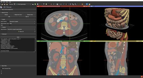 New Extension Fully Automatic Whole Body Ct Segmentation In 2 Minutes