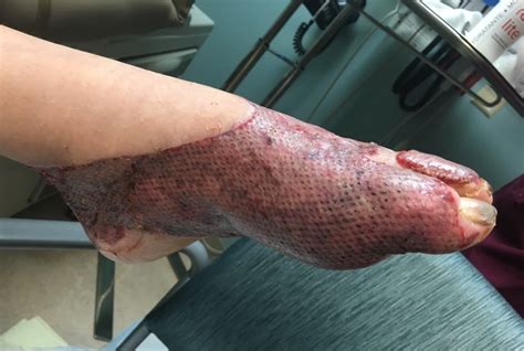 Post‐operative Day 10 Following Tangential Excision And Split‐thickness