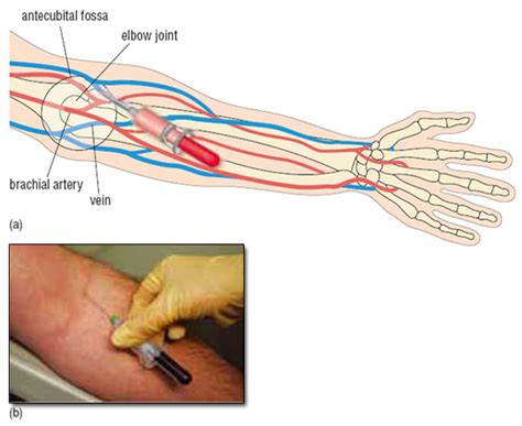 Diabetes Complications Figure 7 A Diagram Of Veins In A Forearm Showing The Antecubital