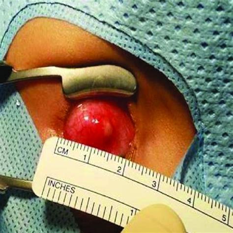 Pdf Infected Conjunctival Pyogenic Granuloma At Strabismus Surgery Site Mimicking Conjunctival