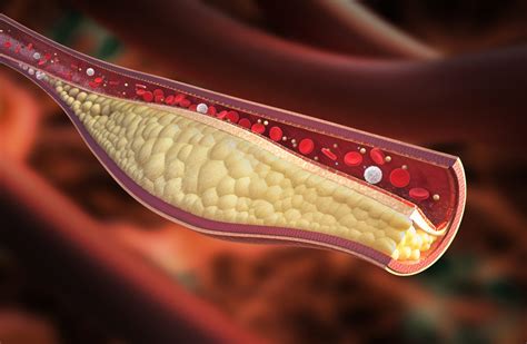 Cholesterol Ferrying Proteins Promote Buildup Of Cardiovascular Plaque