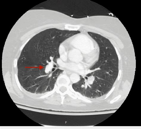 Ct Of Chest With Contrast Showing The Nodule Discovered On Plain