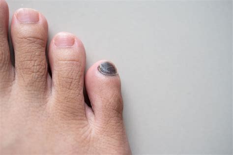 What Causes Your Toenail To Turn Black
