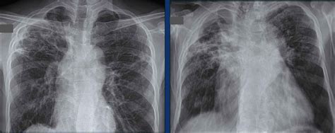 The Radiology Assistant Imaging Findings In Tb
