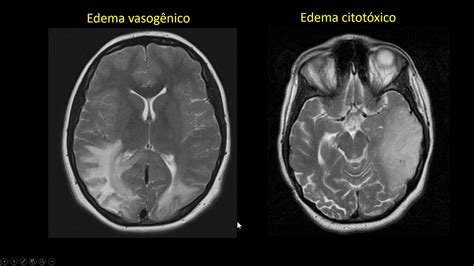 Qué Es Una Patología Cerebral Enfermedad Mental Tbmv