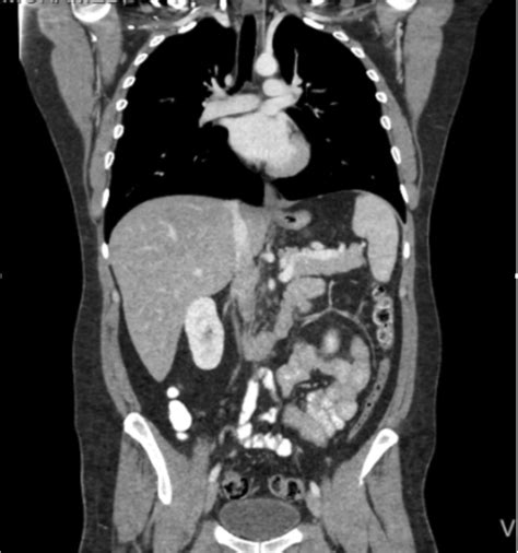 Why Ct Scan Abdomen Pelvis