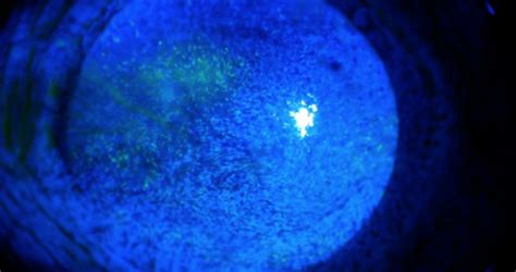 Queratitis OftalmologÍa San JosÉ