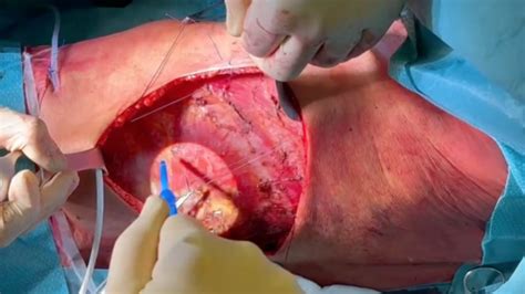 New Video Glubran 2 Spray Application In Breast Reconstructive Plastic