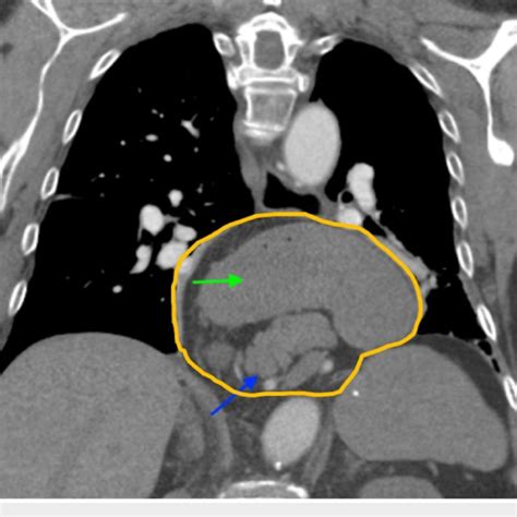 Coronal Ct Angiogram Of The Chest Featuring A Massive Type Iv Hiatal