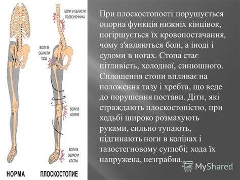 Презентация на тему: "Плоскостопість ". Скачать бесплатно и без ...