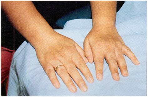 Rheumatology 5 Diagnosis And Management Of Inflammatory Polyarthritis