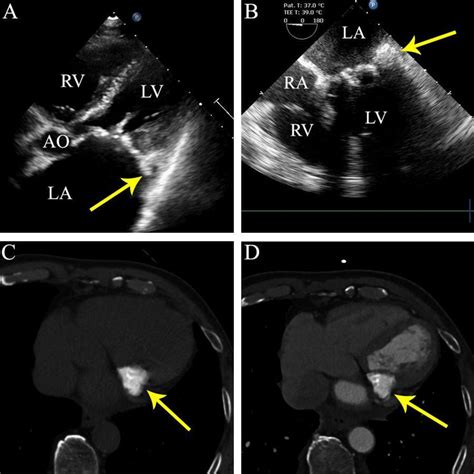 66 Year Old Man With An Intriguing Intracardiac Mass Heart