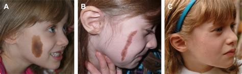 Congenital Melanocytic Nevi Clinics In Plastic Surgery