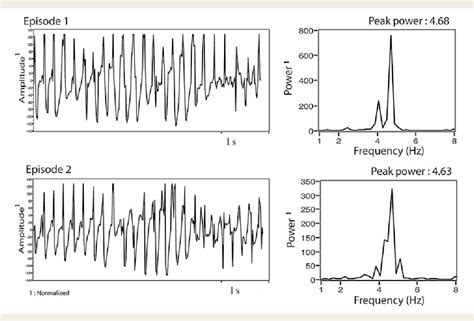 Figure 1 From Ventricular Fibrillation Frequency From Implanted Cardioverter Defibrillator