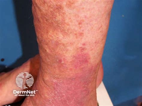Eczema Lower Legs