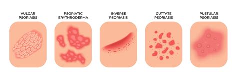 Psoriasis Types Deczéma Allergique Traitement Des éruptions Cutanées