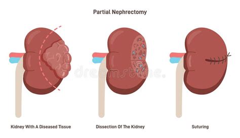 Partial Nephrectomy Surgery Diseased Swelling Tissue Surgical Removal 向量例证 插画 包括有 功能 慢性