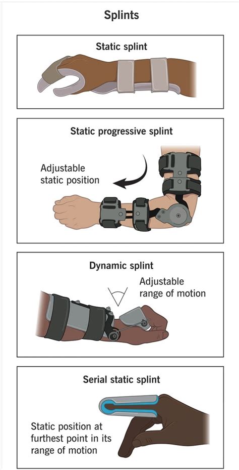 What Are The Most Common Types Of Splints Mohanad Ot Posted On The