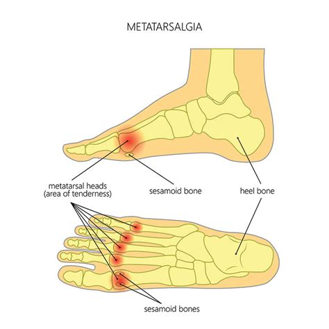 Metatarsal Head View