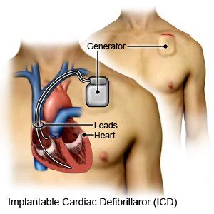 Implantable Cardioverter Defibrillator What You Need To Know