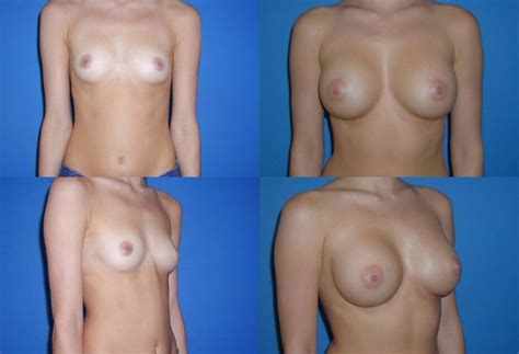 Large C Natural Shaped Breast Before And After Photos Ranch And Coast
