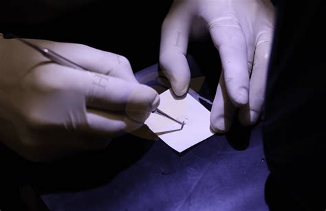 Vital Amputation Of The Pulp Hanima