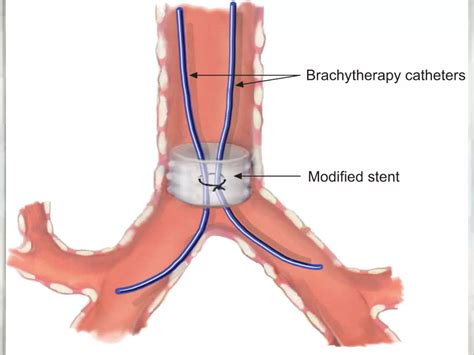 Endobronchial Brachytherapy By Drtinku Joseph Pptx