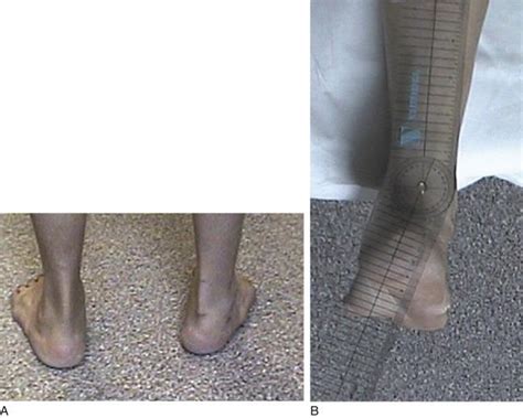 Arthroscopic Talus Fracture Fixation Clinical Tree
