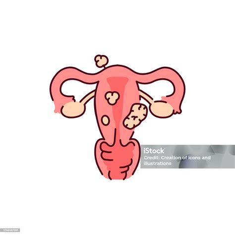 Uterine Myoma Color Line Icon Gynecology Problem Stock Illustration