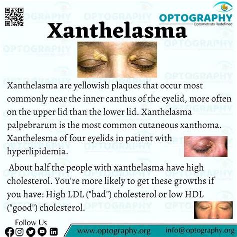 Xanthelasma Vs Xanthoma Xanthelasma Understanding Causes Symptoms