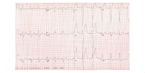 Electrocardiogram Sinus Rhythm Left Bundle Branch Block And Left Download Scientific Diagram