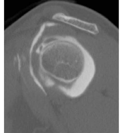 Postoperative Follow Up Sagittal View Of Ct Arthrography Shows The