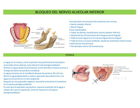 Bloqueo Del Nervio Bucal