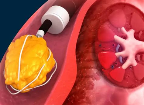 Rirs Lowcost Surgicals